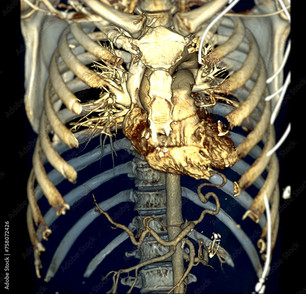 CTA thoracic aorta 3D rendering offers detailed visualization ...