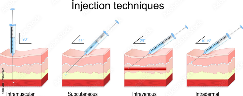 Injection methods. intramuscular, subcutaneous, intravenous, and ...