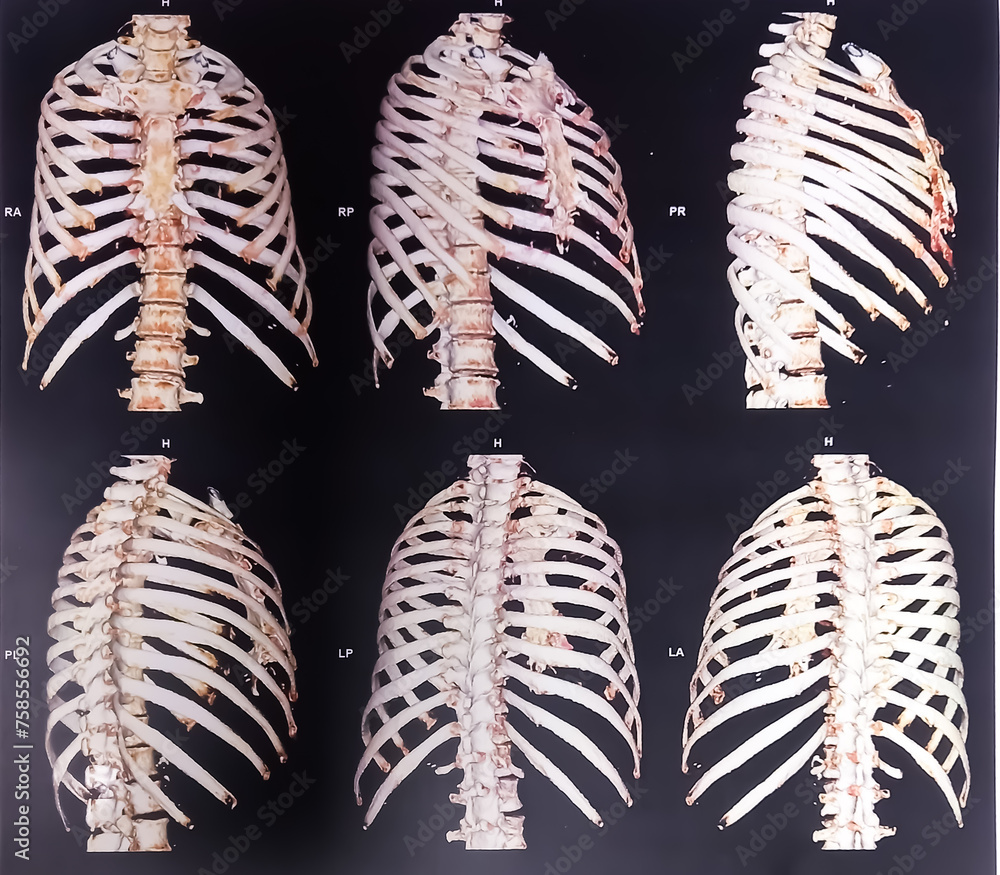 Stock-Foto „3D CT scan Bony thorax, Multiple fractures are present ...