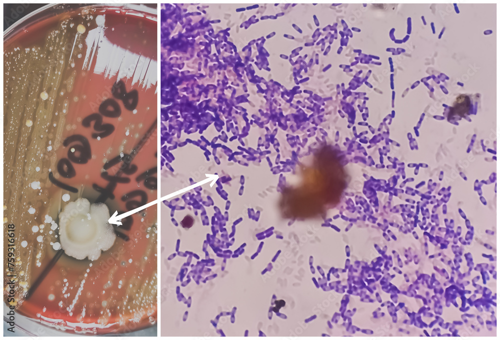 Yeast Infection; Budding yeast and pseudohyphae of Candida albicans ...