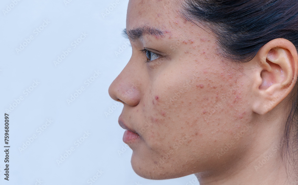 An Asian teenage girl with uneven facial skin problems. The invasion of ...