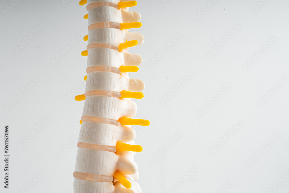 Lumbar spine displaced herniated disc fragment, spinal nerve and bone ...