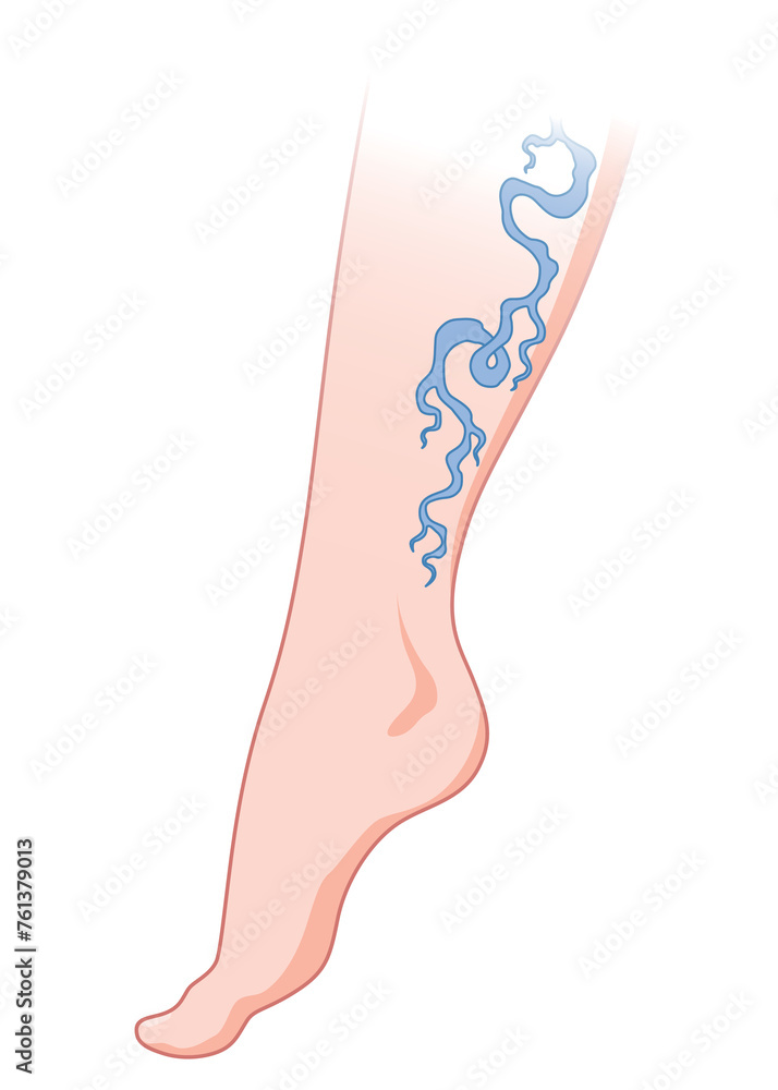 Varicose veins. Blue blood vessel visible through the skin, abnormally ...