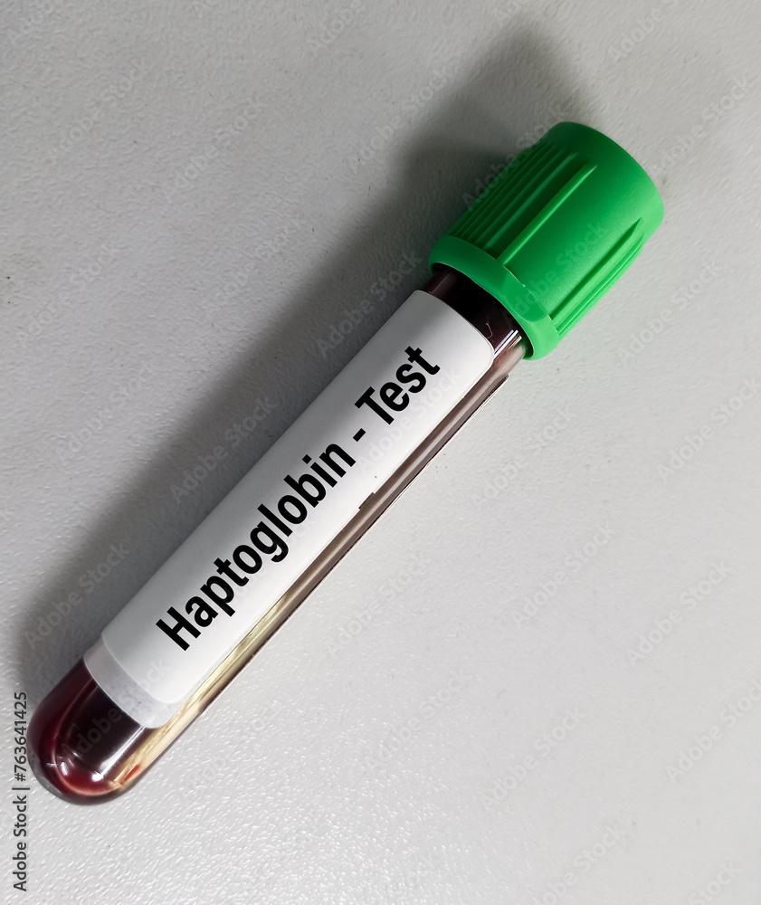 Blood sample tube with sample for Haptoglobin test, diagnosis for ...