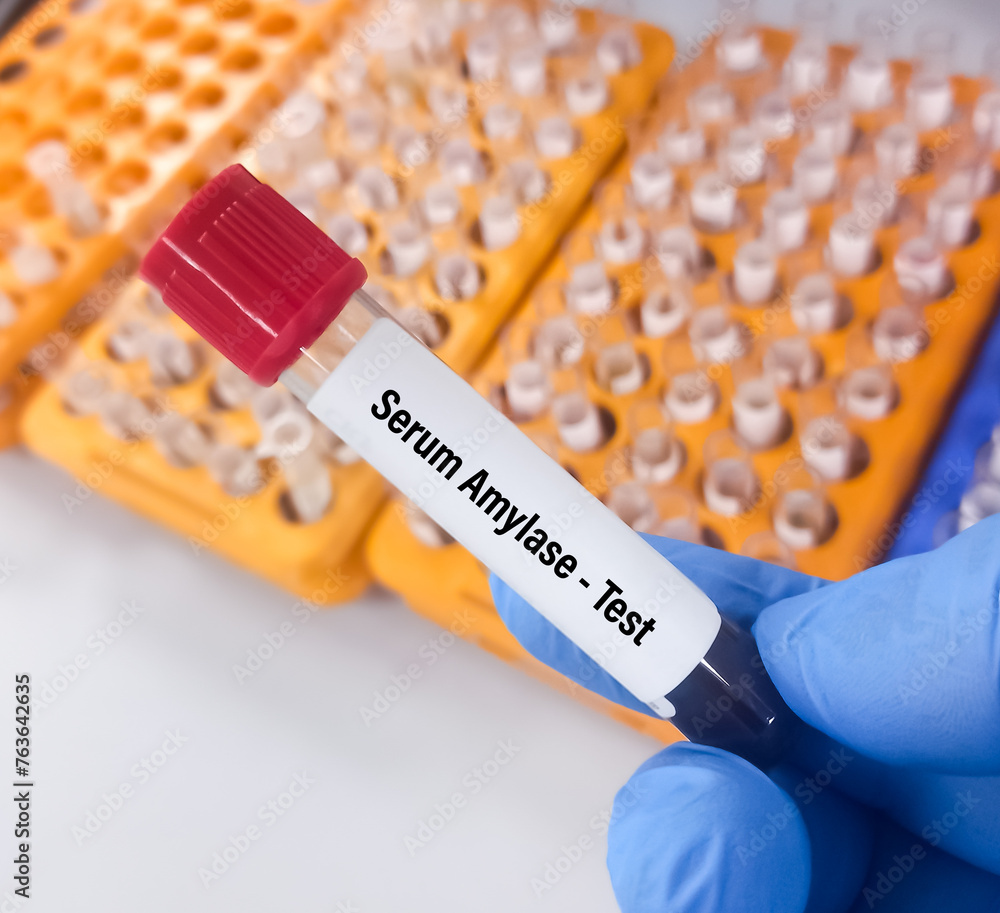 Biochemist holds blood sample for Serum Amylase test, to diagnosis of ...