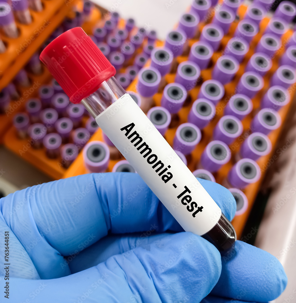 Blood sample for Ammonia test to diagnosis of ammonia levels also known ...