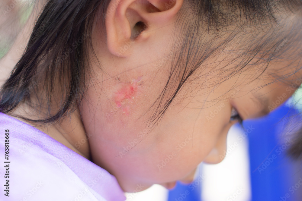 Scar on the face of an Asian girl and his sad face. Scar after surgery ...