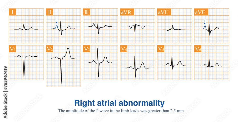 Male, 67 years old, with a clinical diagnosis of chronic obstructive ...