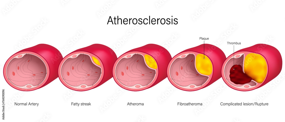 Atherosclerosis vector. Cardiovascular Disease. Coronary artery ...