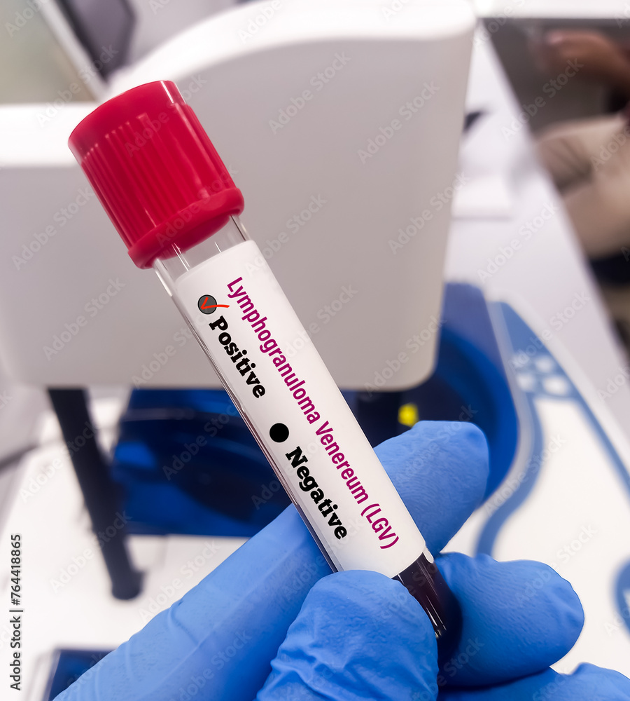 Stock-Foto „Blood sample for Lymphogranuloma Venereum (LGV) disease ...