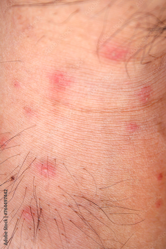 There are red bumps on the feet from fire ants biting the back of the ...