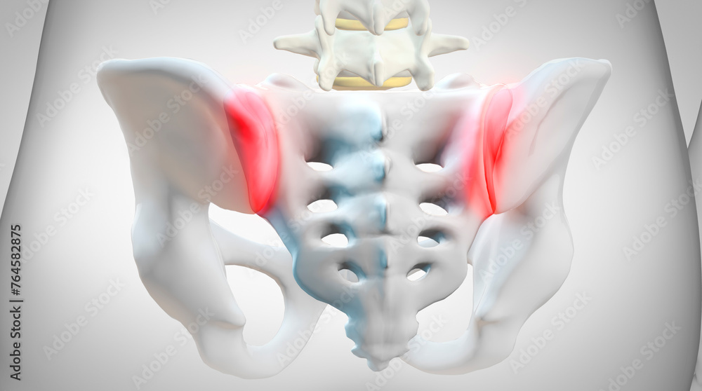 Inflammation of sacroiliac joints, illustration Stock Illustration ...