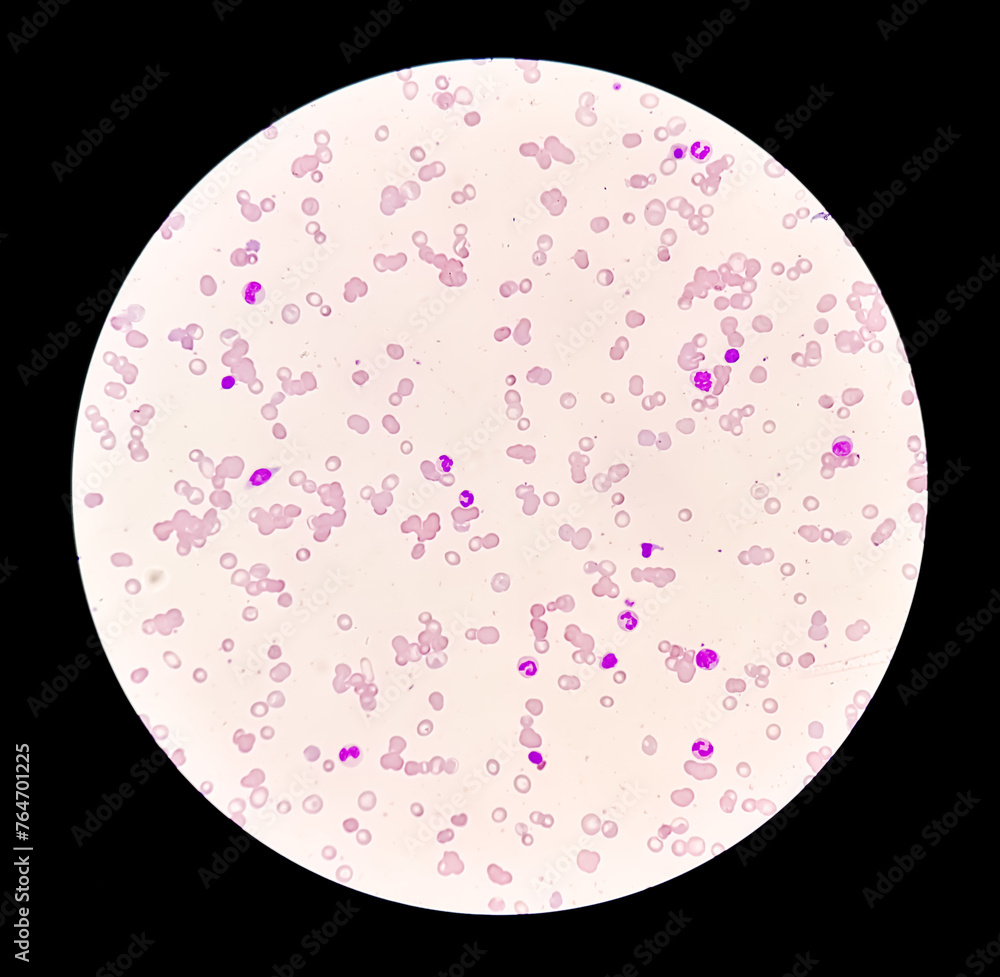 Photomicrograph of hematological slide showing severe anemia. Hemolytic ...