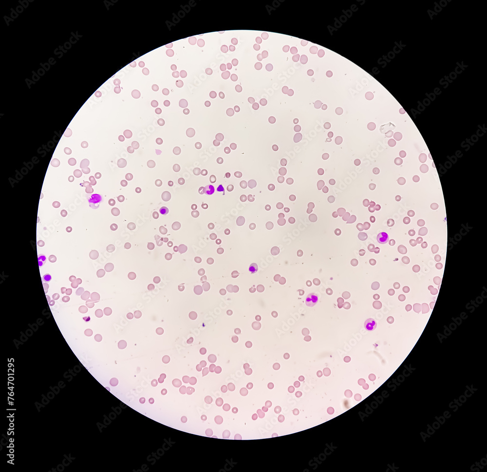 Photomicrograph of hematological slide showing severe anemia. Hemolytic ...