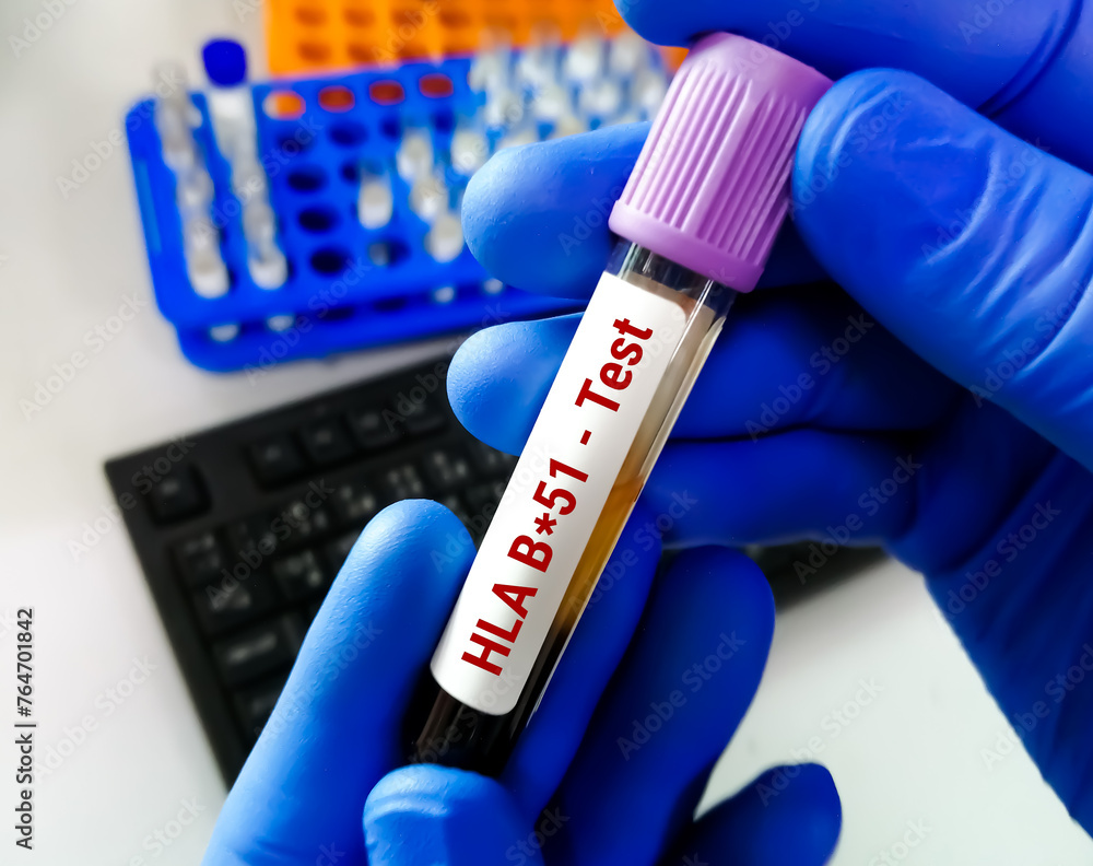 Blood sample for HLA B51 (human leukocyte antigen). to diagnose Behcet ...