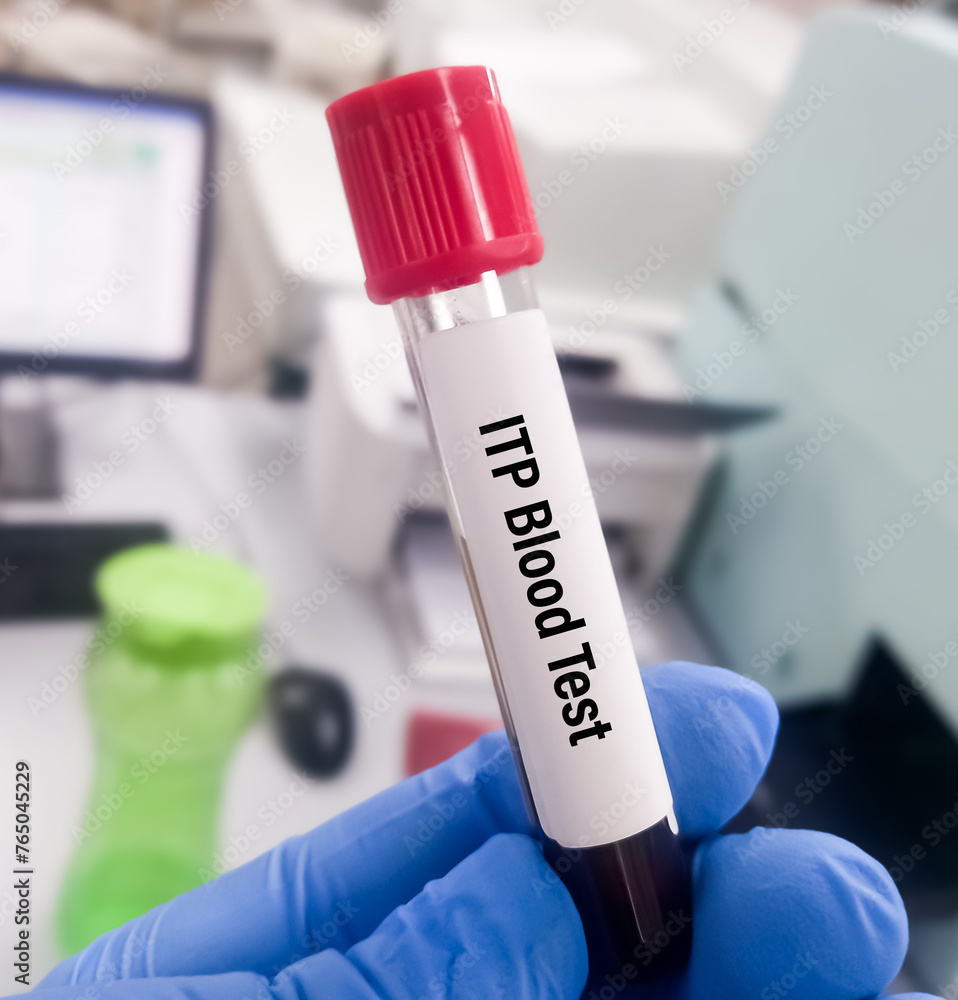 Blood sample for Immune Thrombocytopenic Purpura (ITP) test, idiopathic ...