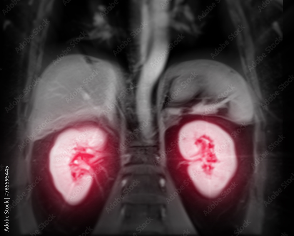 MRI of the upper abdomen is a non-invasive imaging technique providing ...