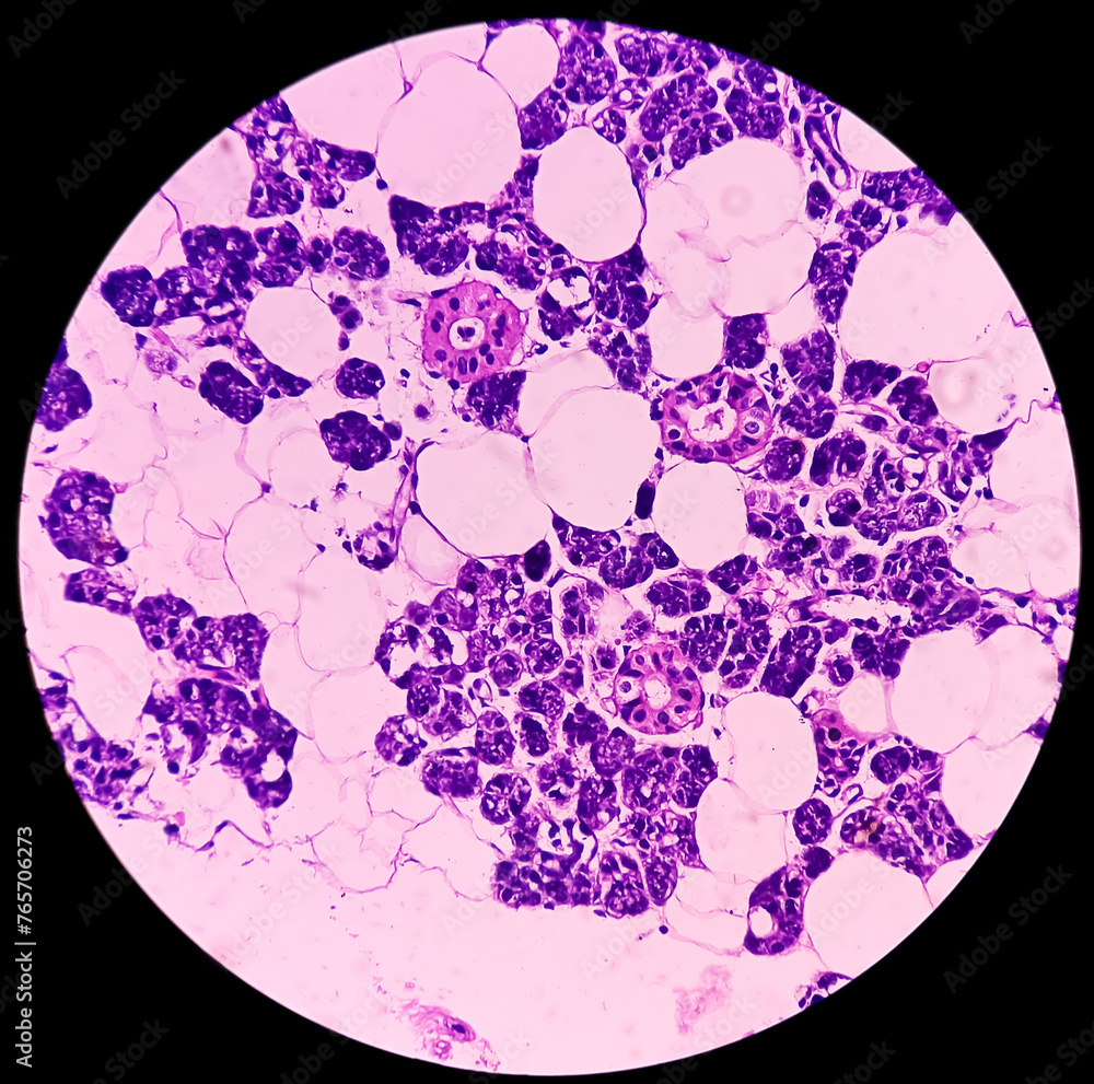 Foto de Stock Salivary mucoid cyst. microscopic show parotid tissue ...