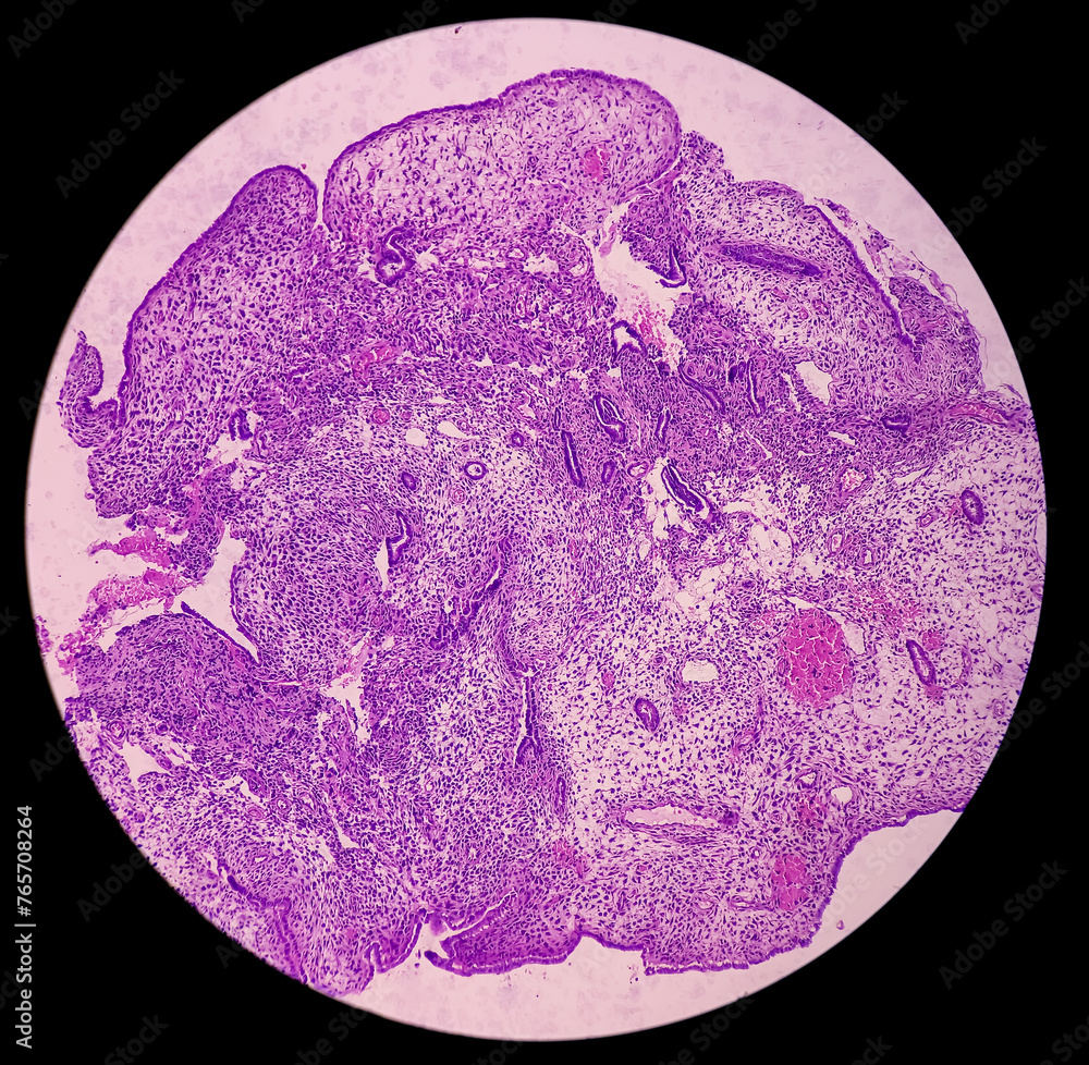 Microphotograph of endometrial tissue, reveals decidual change with ...