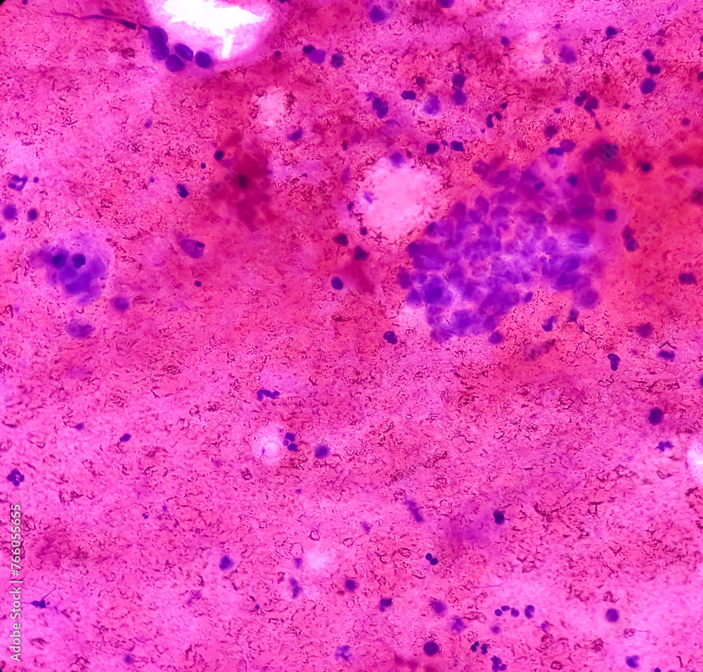 CT guided FNA from lung lesion, Chronic granulomatous inflammation (CGI ...