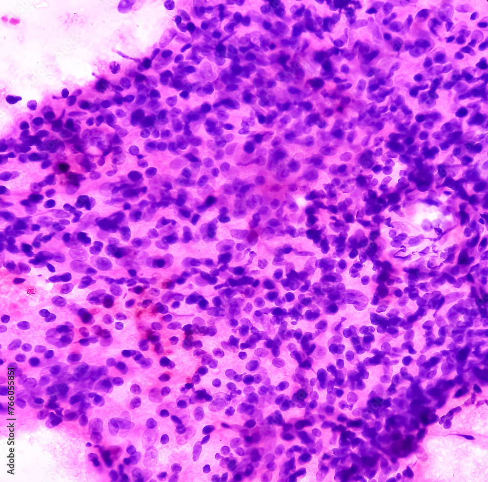 Stock-Foto „Photomicrograph of Chronic granulomatous inflammation (CGI ...