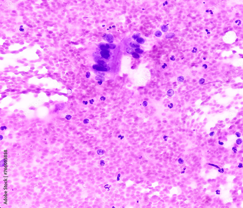 CT guided FNA from lung lesion, Chronic granulomatous inflammation (CGI ...