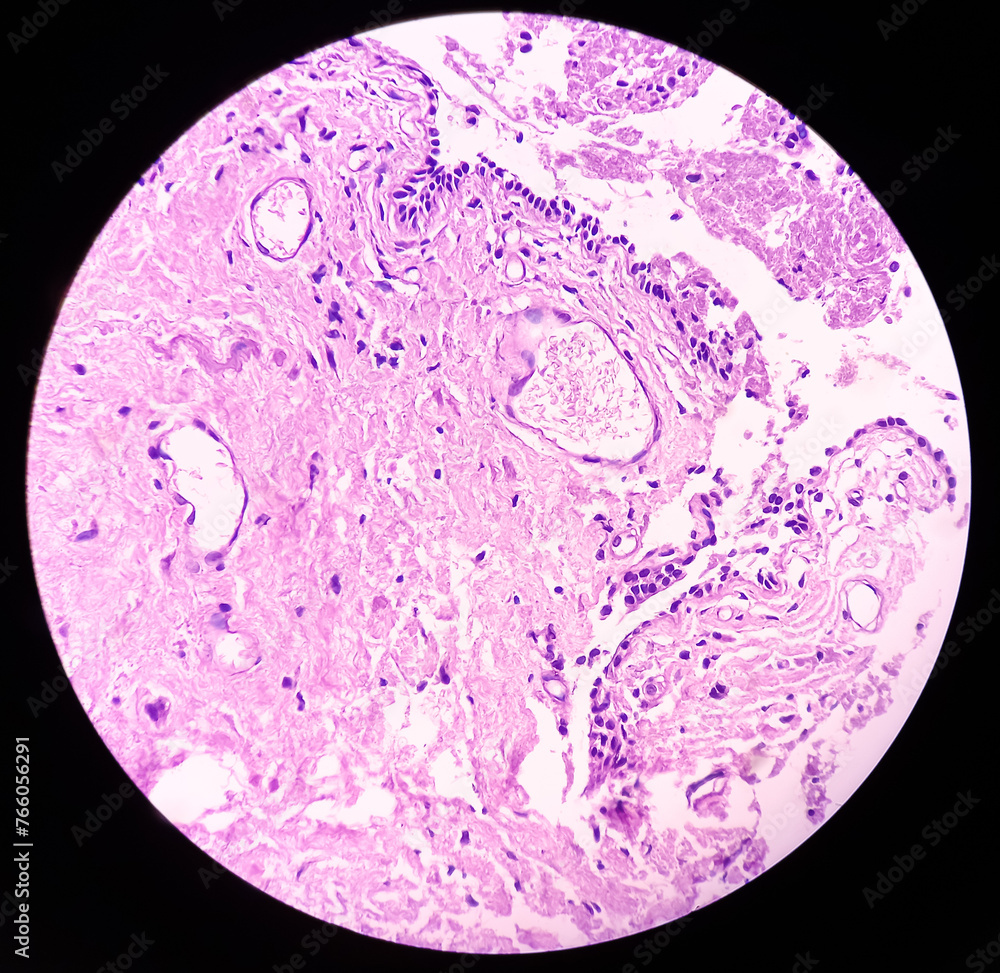 Illustration Stock Urachal cyst or Urethral cyst (biopsy ...