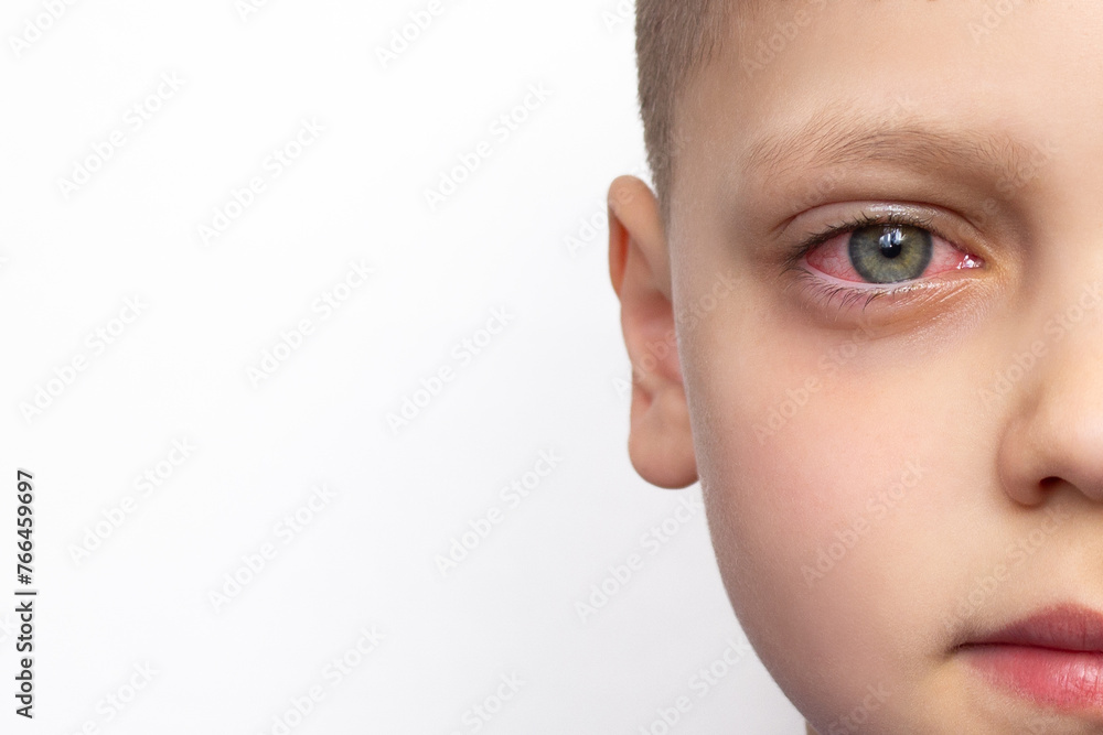 Closeup of a child's face with a red eye, isolated on a white ...