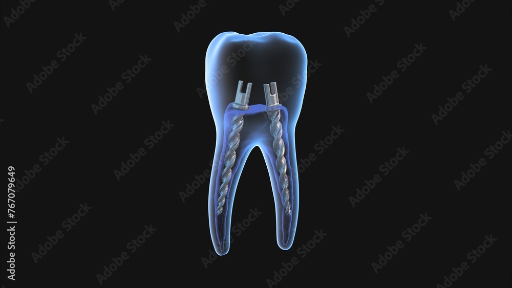 Dental steel post inside molar teeth, Xray view. Dental endodontic ...