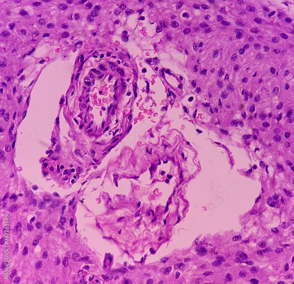 Parietal lesion(biopsy): Brain cancer, Meningioma, show neoplasm of ...