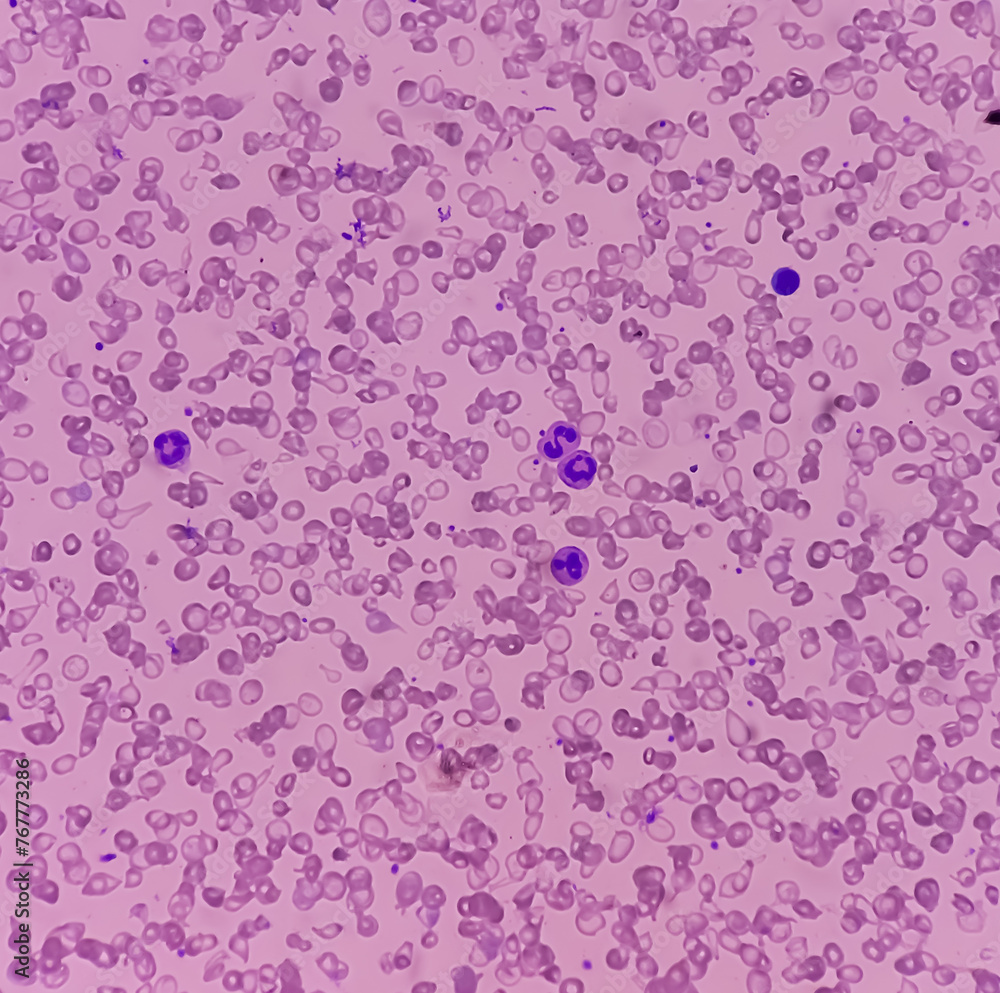 Foto de Stock Blood smear, Hereditary hemolytic anemia. Hemoglobin E ...