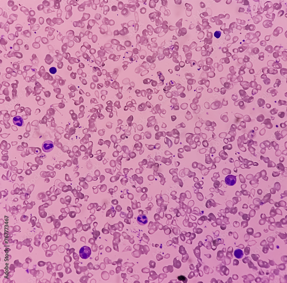 Blood smear, Hereditary hemolytic anemia. Hemoglobin E (HbE) disease ...