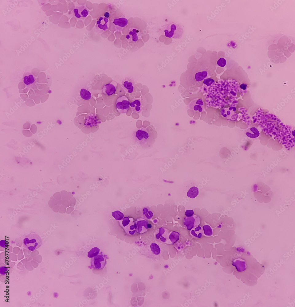 Foto de Stock Blood smear, Hereditary hemolytic anemia. Hemoglobin E ...