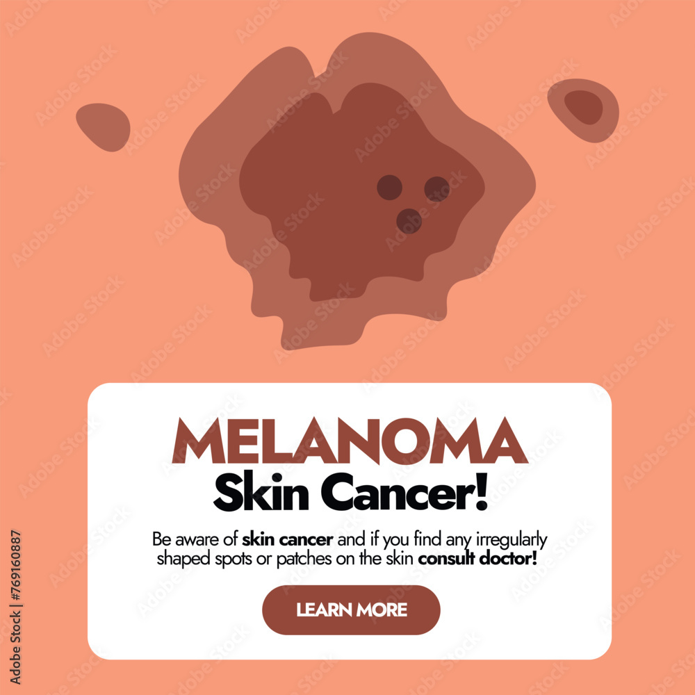 Image vectorielle Stock Melanoma skin cancer cell. Skin disease ...