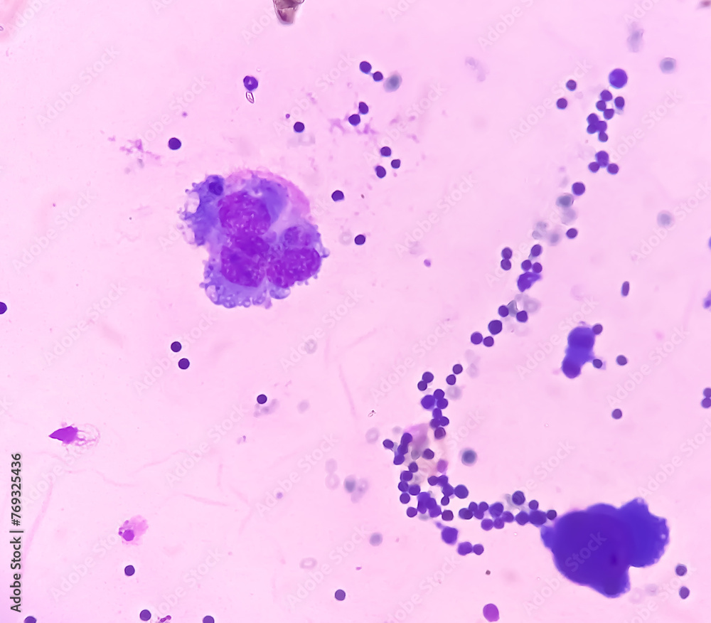 Ascitic fluid cytology. Leishman stain smear show Lymphocytes ...