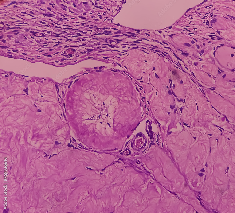 Стоковое фото «Uterus with adnexa (biopsy): Cervix show chronic ...