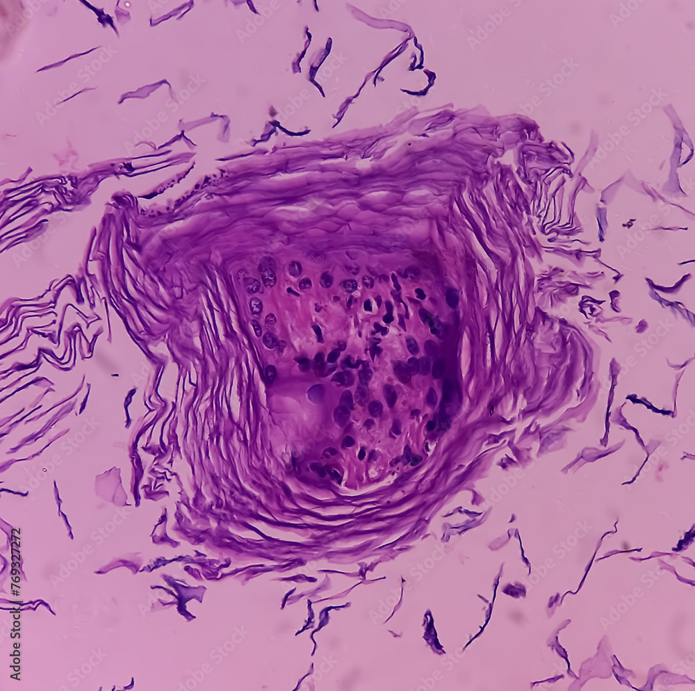 Mature cystic teratoma, Ovarian cyst biopsy, show cyst wall of skin and ...