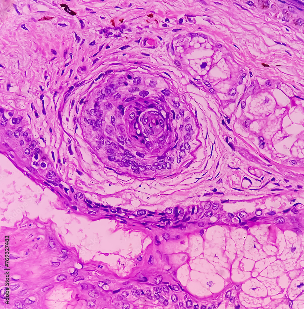 Mature cystic teratoma, Ovarian cyst biopsy, show cyst wall of skin and ...