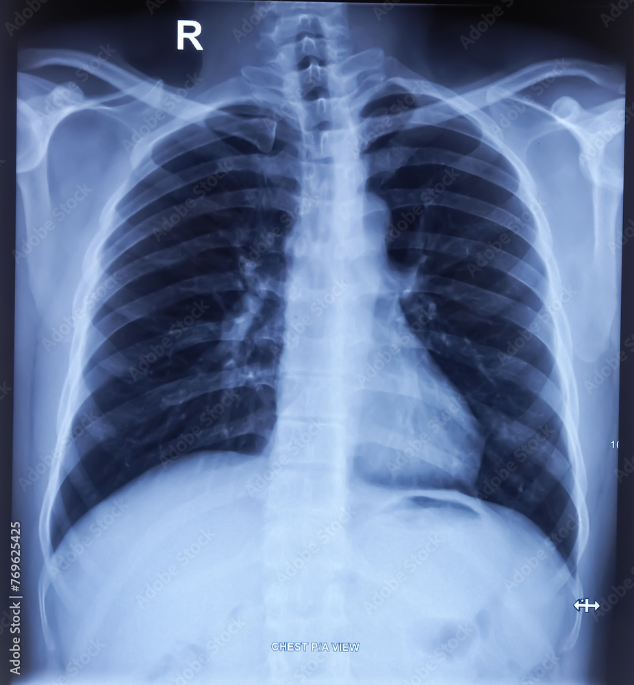 CXR (Chest X-Ray) PA view. normal findings. Stock Photo | Adobe Stock