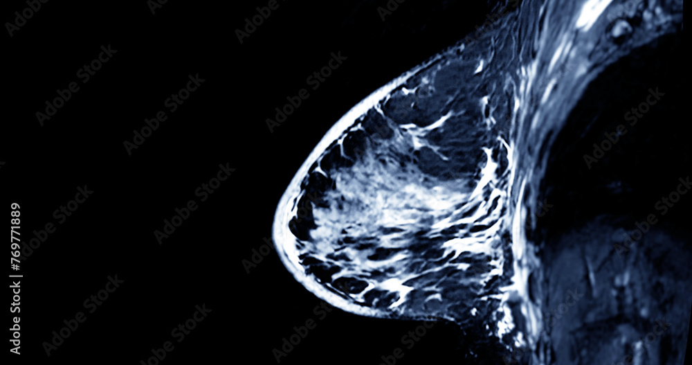Breast MRI revealing BI-RADS 4 in women indicates suspicious findings ...