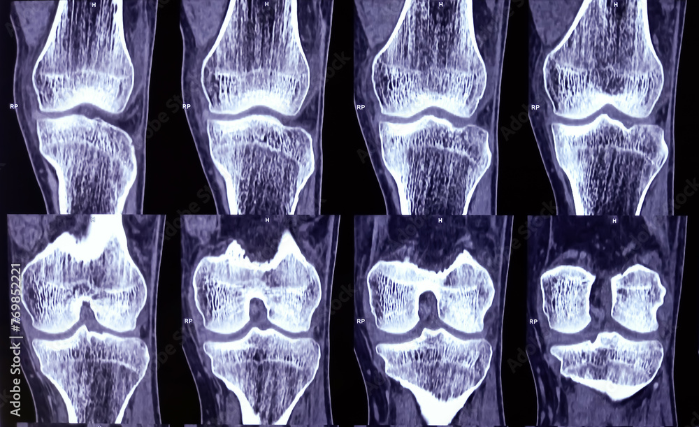 CT scan of Knee joint. knee joint alignment and congruity maintained ...