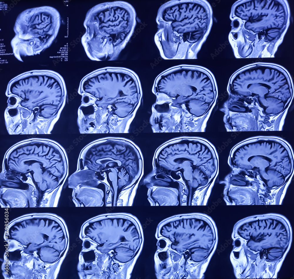 MRI (Magnetic Resonance Image) of brain. Cerebral cortical atrophy ...