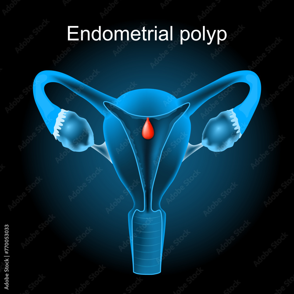 Endometrial polyp. Cross section of a human uterus with Uterine polyp ...