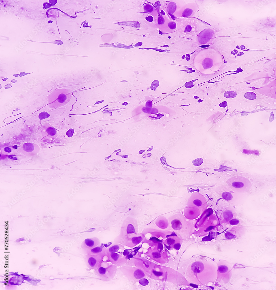 Light micrograph of a vaginal smear showing adenocarcinoma cells ...