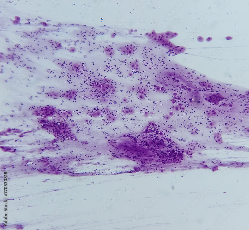 Light micrograph of a vaginal smear showing adenocarcinoma cells ...