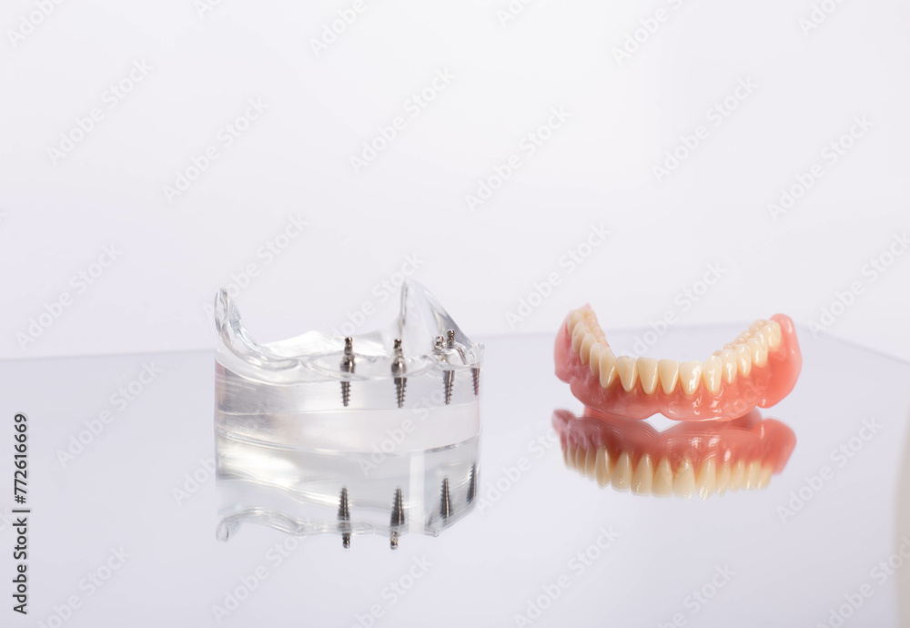 render of mandibular prosthesis all on 4 system supported by implants ...