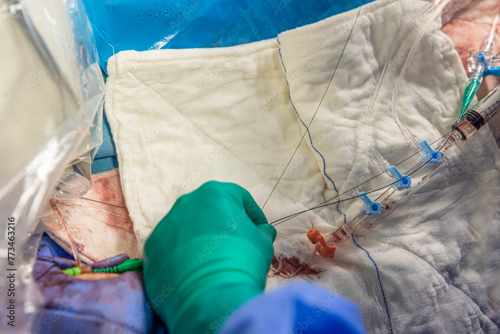 Foto de Stock Heart stent placement process in operating room. Heart ...