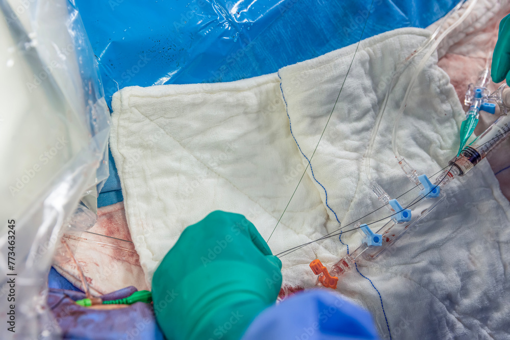 Heart stent placement process in operating room. Heart doctor inserting ...