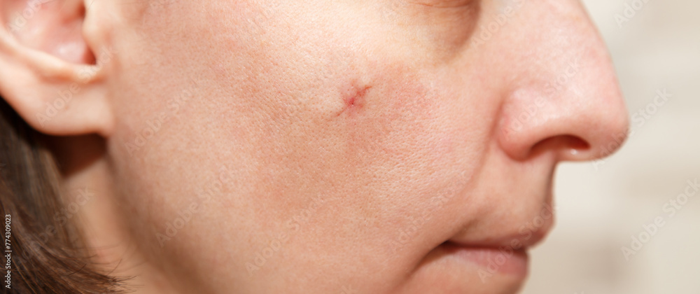 Photo Stock Real scar on the young woman face, scar on the cheek after ...