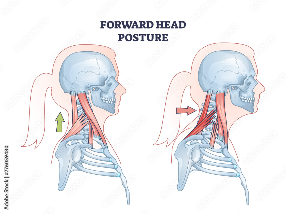 Stock-Vektorgrafik „Forward head posture compared with healthy neck ...